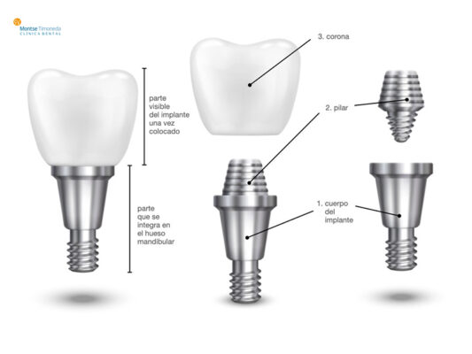 Partes del implante dental: Descubre sus componentes esenciales ...